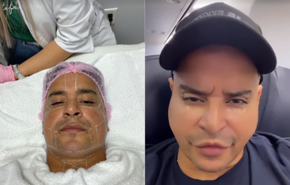 Após procedimento estético no rosto, Xanddy faz mistério nas redes ...