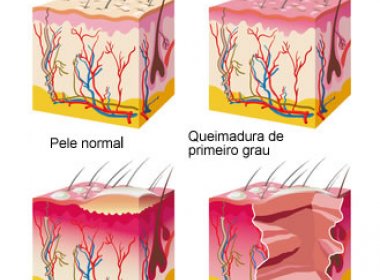 Saiba como tratar queimaduras na pele - Bahia Notícias
