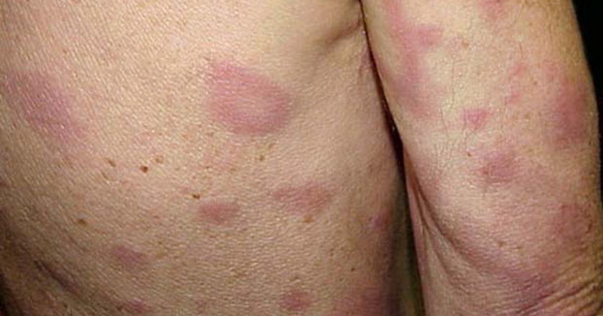 Número de casos de hanseníase volta a crescer no Brasil após 13 anos em ...